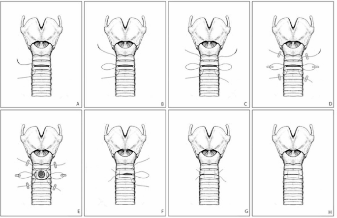 The dragonfly technique for trachea closure in temporary tracheostomies ...