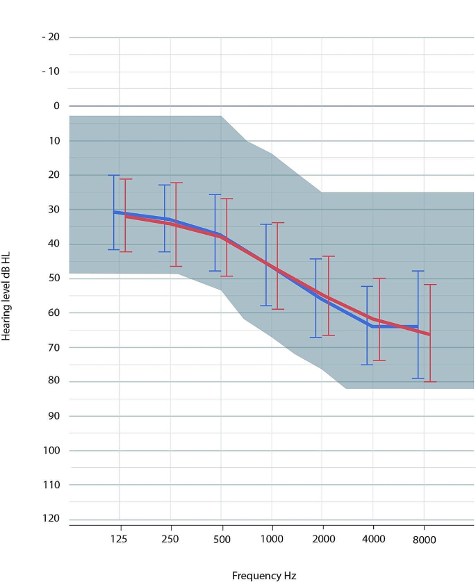 Open-fitting hearing aids: a comparative analysis between open behind ...