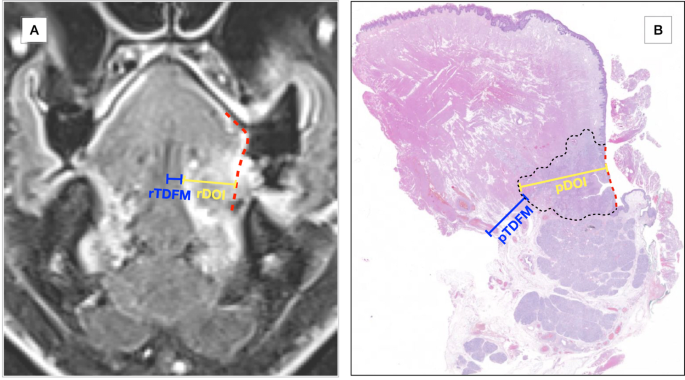 Role of midline raphe in compartmental surgery for squamous cell ...