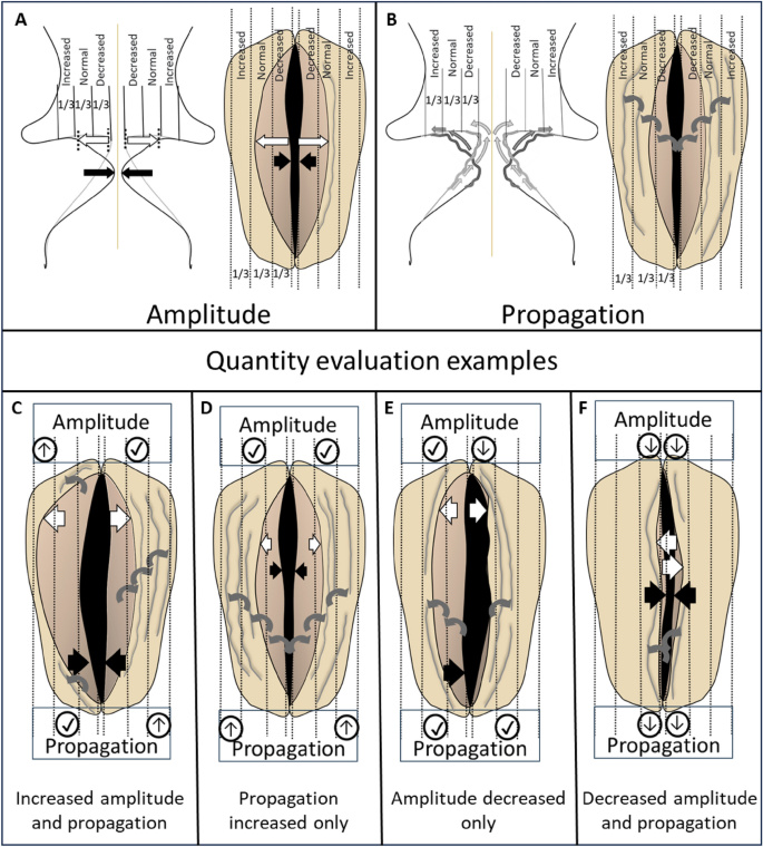 Scale for the assessment of mucosal wave dynamics of the free edges ...