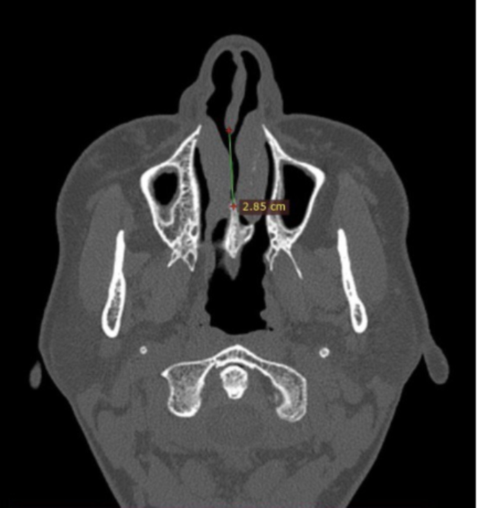 Endoscopic septal perforation repair by endonasal flap: a technique ...