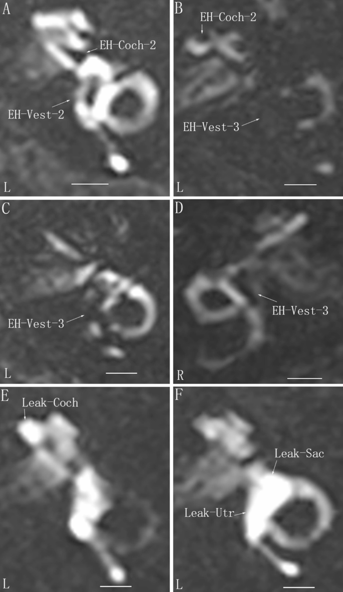 Endolymphatic hydrops impairs inner ear uptake and distribution of ...