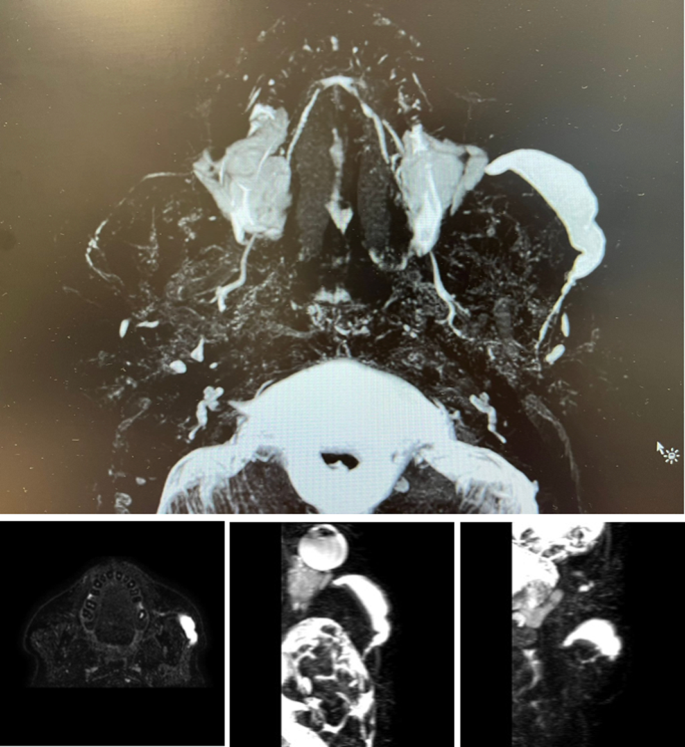 Sialodochoplasty with ductal size reduction for Stensen’s megaduct ...