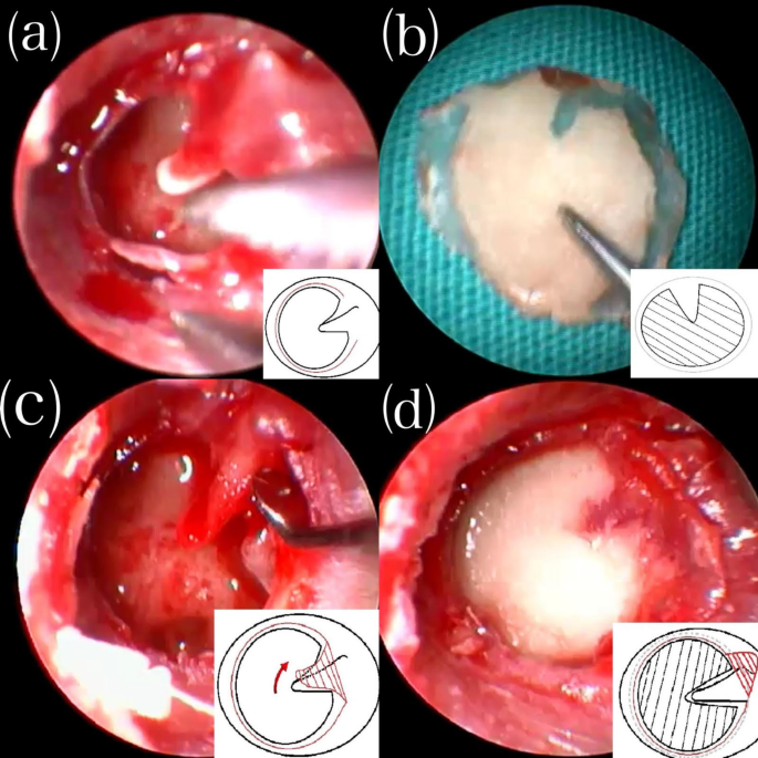 Preliminary results of a new endoscopic underlay cartilage ...