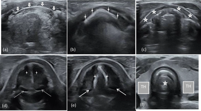 Role of high resolution laryngeal ultrasound in evaluation of laryngeal ...