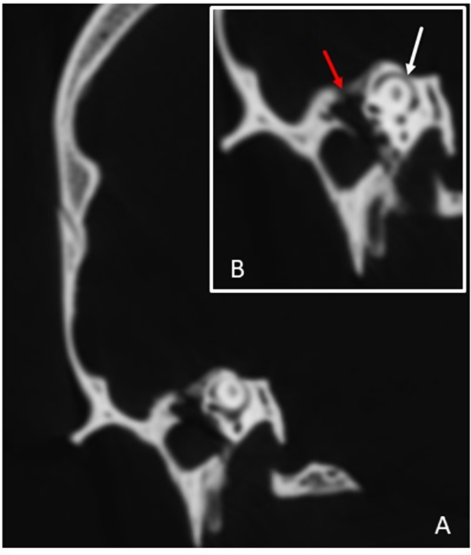 Double dehiscence (Superior semicircular canal and tegmen tympani) in ...