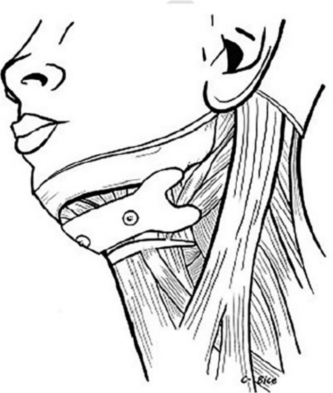 Examining swallowing parameters of the Yale Swallow Protocol in healthy ...