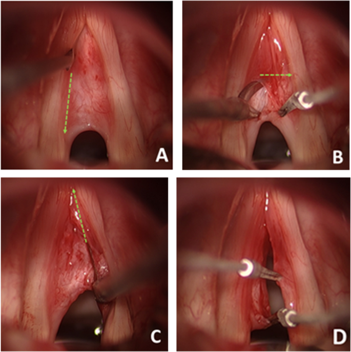 Bi-layered microflap surgery for the treatment of anterior glottic web ...