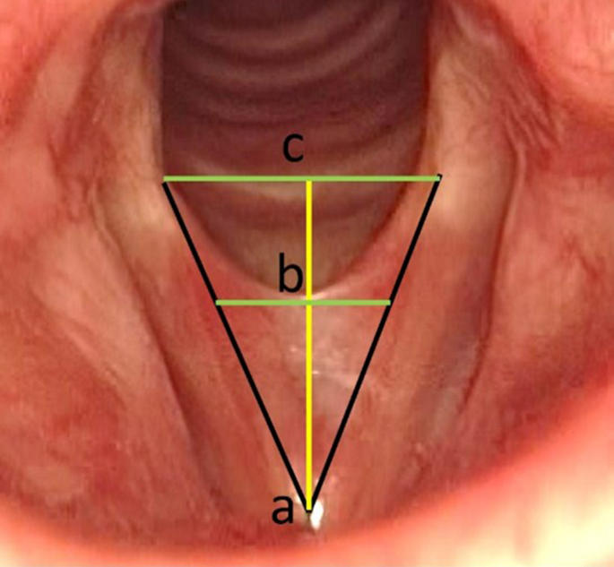 Bi-layered microflap surgery for the treatment of anterior glottic web ...
