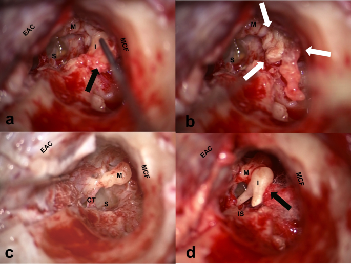 Efficacy of incus reposition ossiculoplasty in middle ear cholesteatoma ...