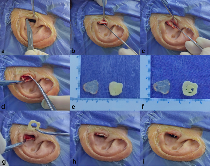 Clinical application of a modified cartilage ring reposition technique ...