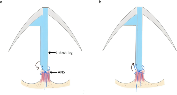 Dual-stage septum-to-nasal spine fixation suture for enhanced caudal ...