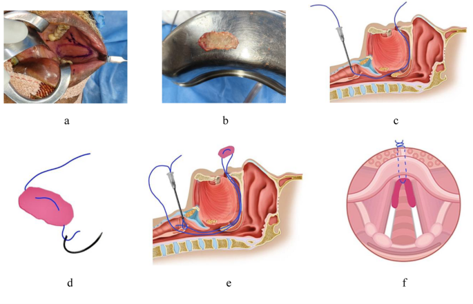 Single stage transcutaneous suture fixation of anterior commissure ...