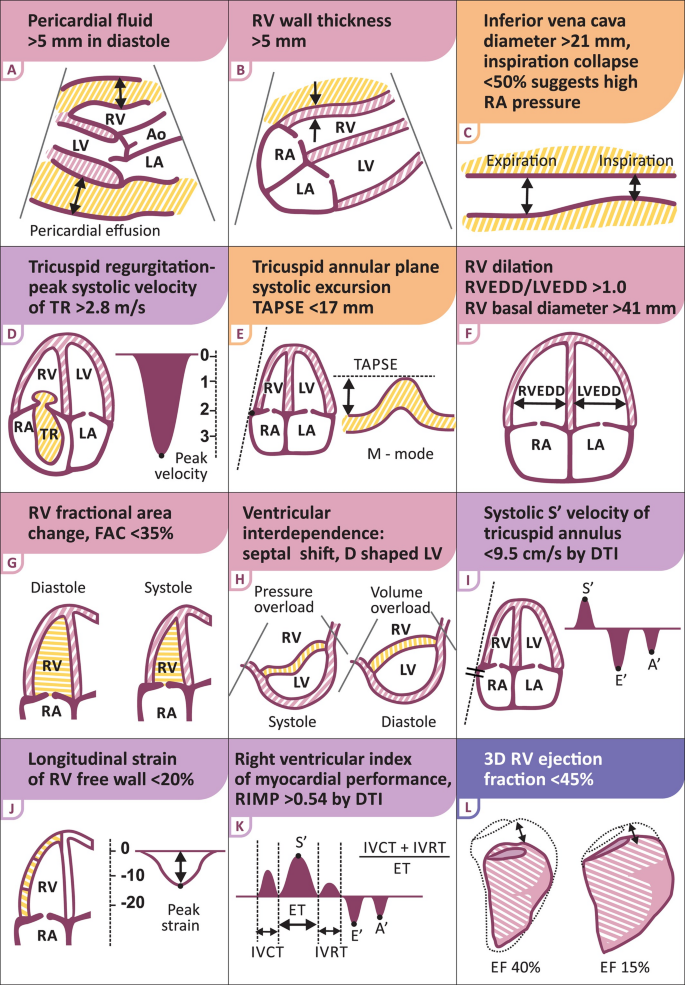 Acute Right Ventricular Failure in the Medical ICU | Lung