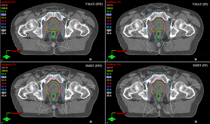 Stereotactic body radiation therapy for prostate cancer: a dosimetric ...