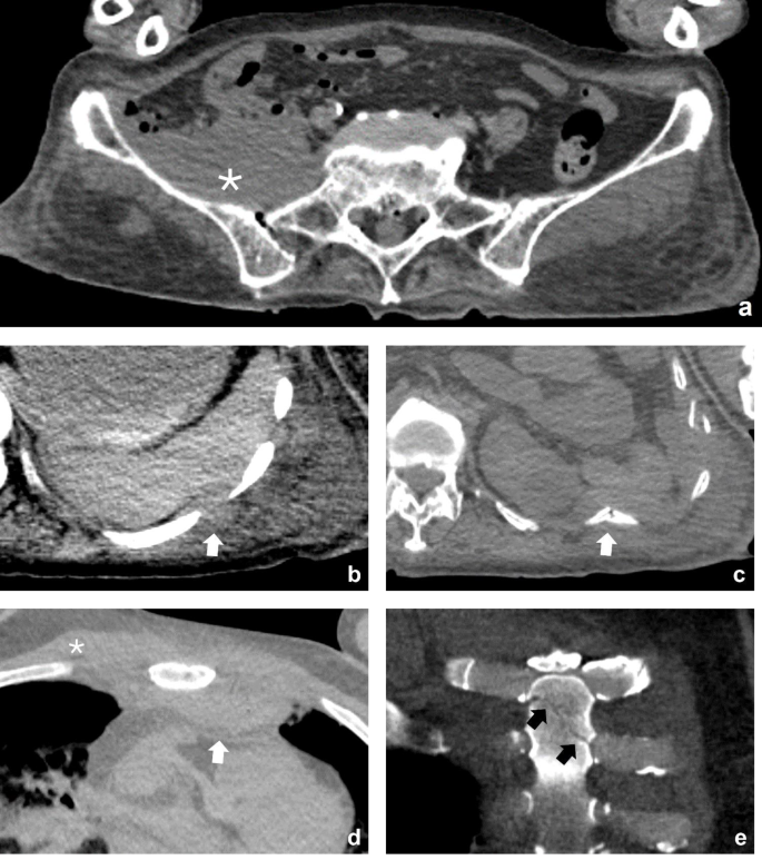 Forensic insights into primary pyomyositis: autopsy and post-mortem CT ...