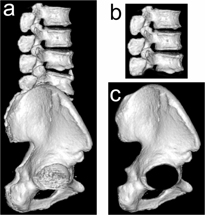 Development of an age estimation method for the coxal bone and lumbar ...