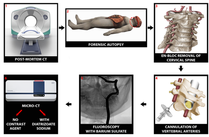 Ex-situ identification of vertebral artery injuries from stab wounds ...