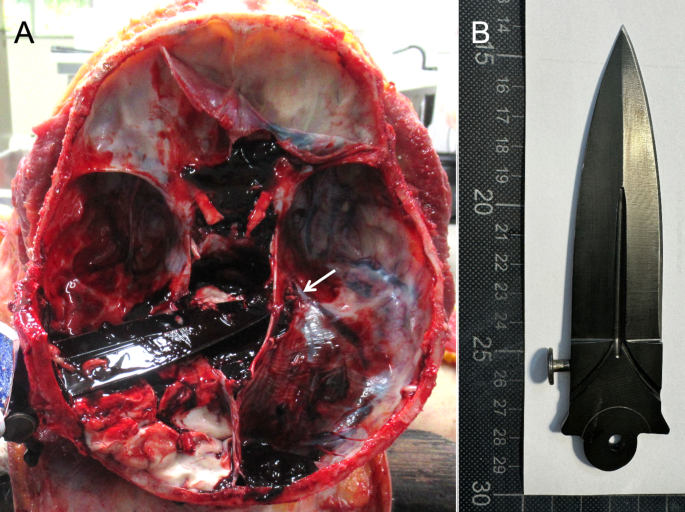 Experimental determination of the stabbing intensity in an intracranial ...