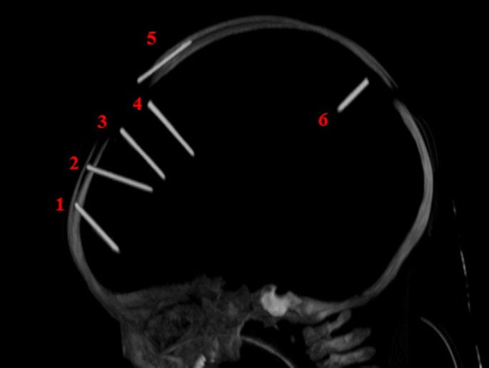 Intracranial needle insertion into an infant’s brain: a case report ...