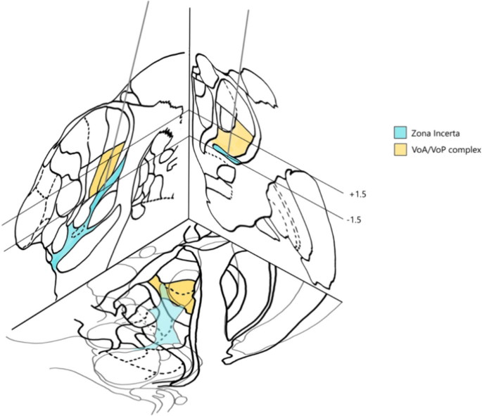 Thalamic ventral-Oralis complex/rostral zona incerta deep brain ...
