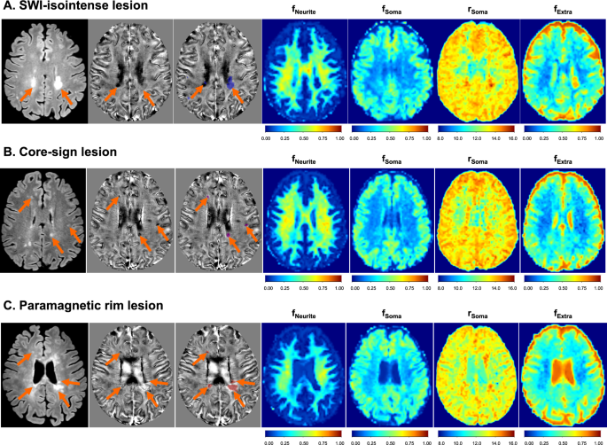 Soma and neurite density abnormalities of paramagnetic rim lesions and ...