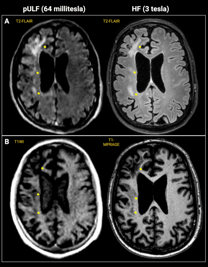 Portable ultra-low-field MRI for progressive multifocal ...