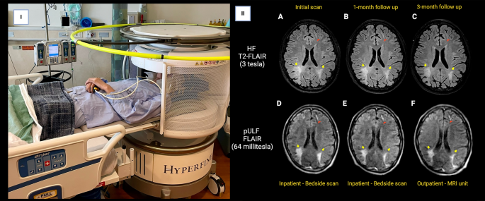 Portable ultra-low-field MRI for progressive multifocal ...