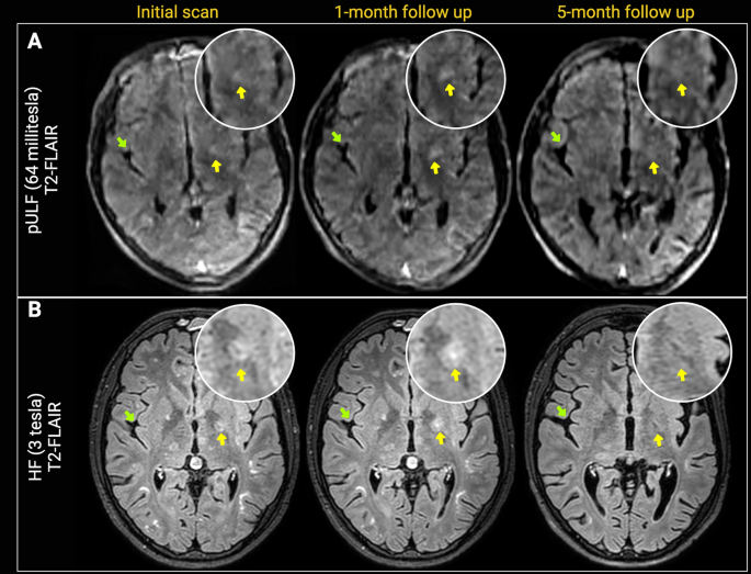 Portable ultra-low-field MRI for progressive multifocal ...