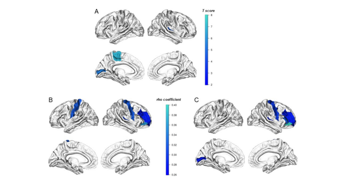 Pathological laugher and crying in motor neuron diseases: a matter of ...