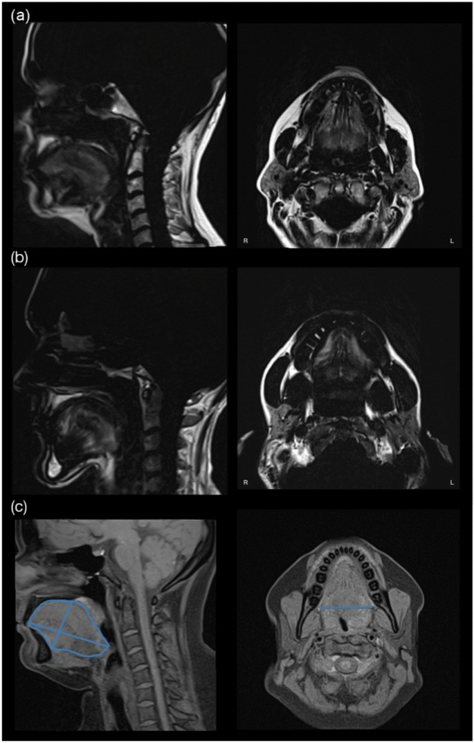 Whole-body muscle MRI in patients with spinal muscular atrophy ...