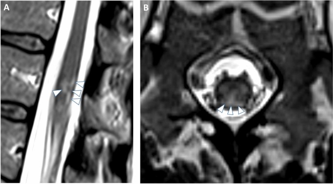 Rare case of spontaneous predominantly posterior infarction of the ...