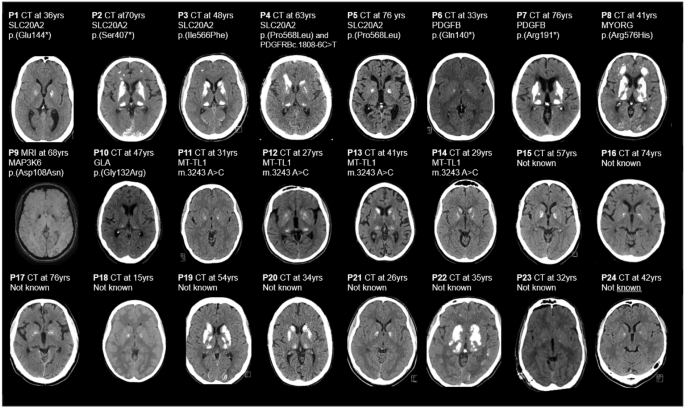 Genetic background of neurological disorders with basal ganglia ...