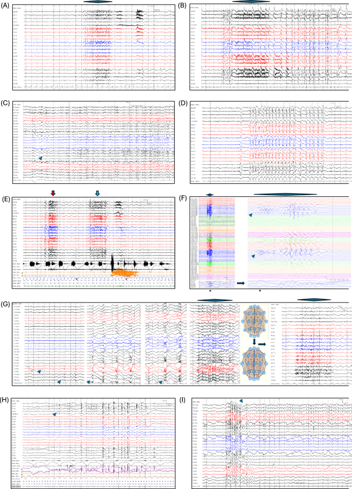 Refractory focal epilepsy evolving into a Lennox–Gastaut syndrome-like ...