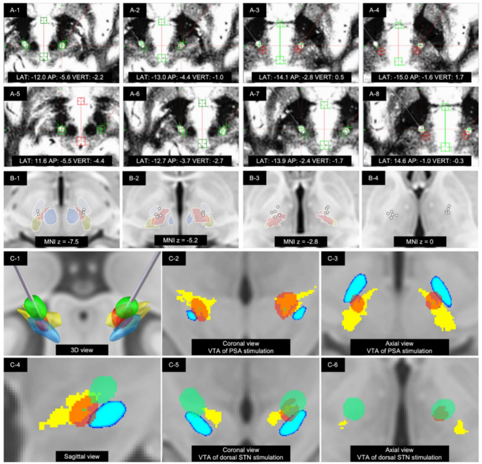 Efficacy and safety of single-trajectory posterior subthalamic area and ...