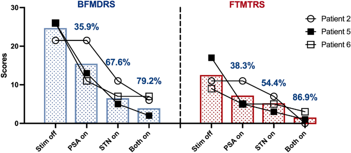 Efficacy and safety of single-trajectory posterior subthalamic area and ...
