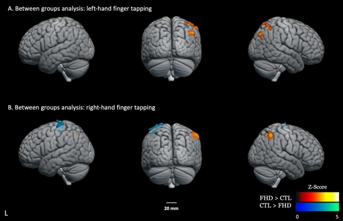 “Tapping” into neural inhibition in focal hand dystonia: an evaluation ...