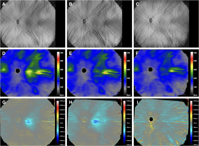 One-year choroidal thickness changes after photodynamic therapy for ...