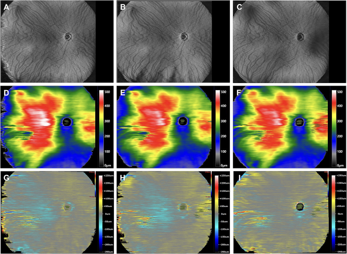 One-year choroidal thickness changes after photodynamic therapy for ...