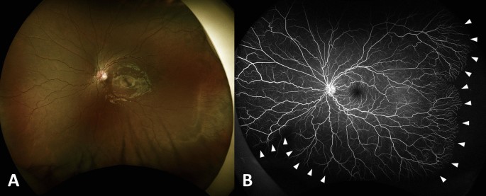 Persistent avascular retina in retinopathy of prematurity | Graefe's ...