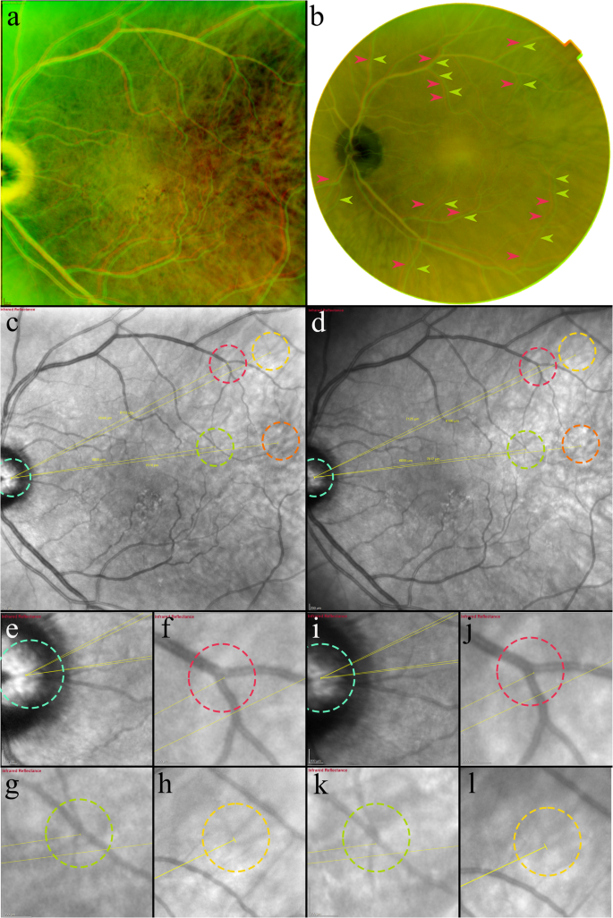 Displacement of the retina in the late follow-up after retinal ...