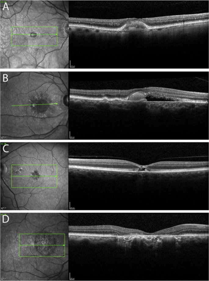 Cataract surgery in eyes with adult-onset foveomacular-vitelliform ...