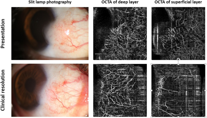 Optical coherence tomography angiography in evaluating the response of ...