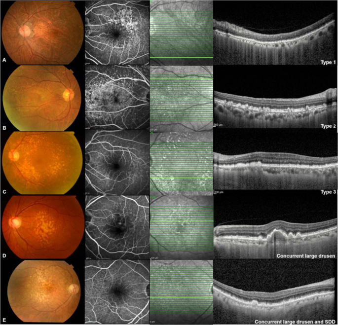 Cuticular drusen in Asian neovascular age-related macular degeneration ...