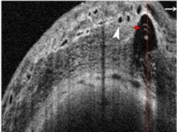 Bleb characteristics following minimally invasive bleb surgeries in ...