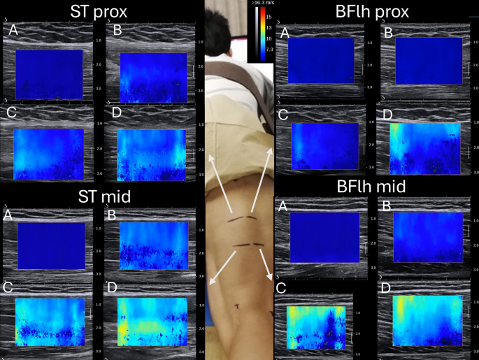 Intra- and intermuscular shear wave speed distributions in the human ...