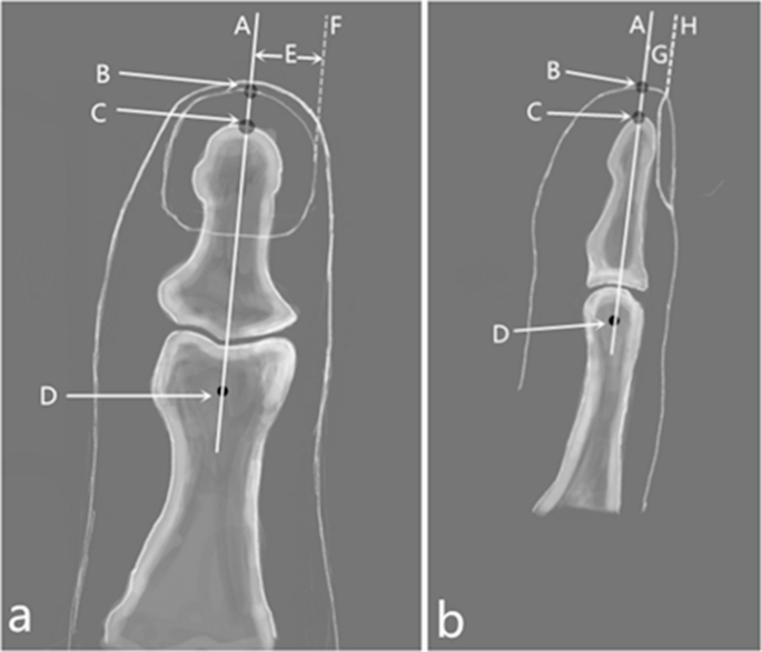 Localizing retrograde K-wire insertion points in distal phalanges using ...