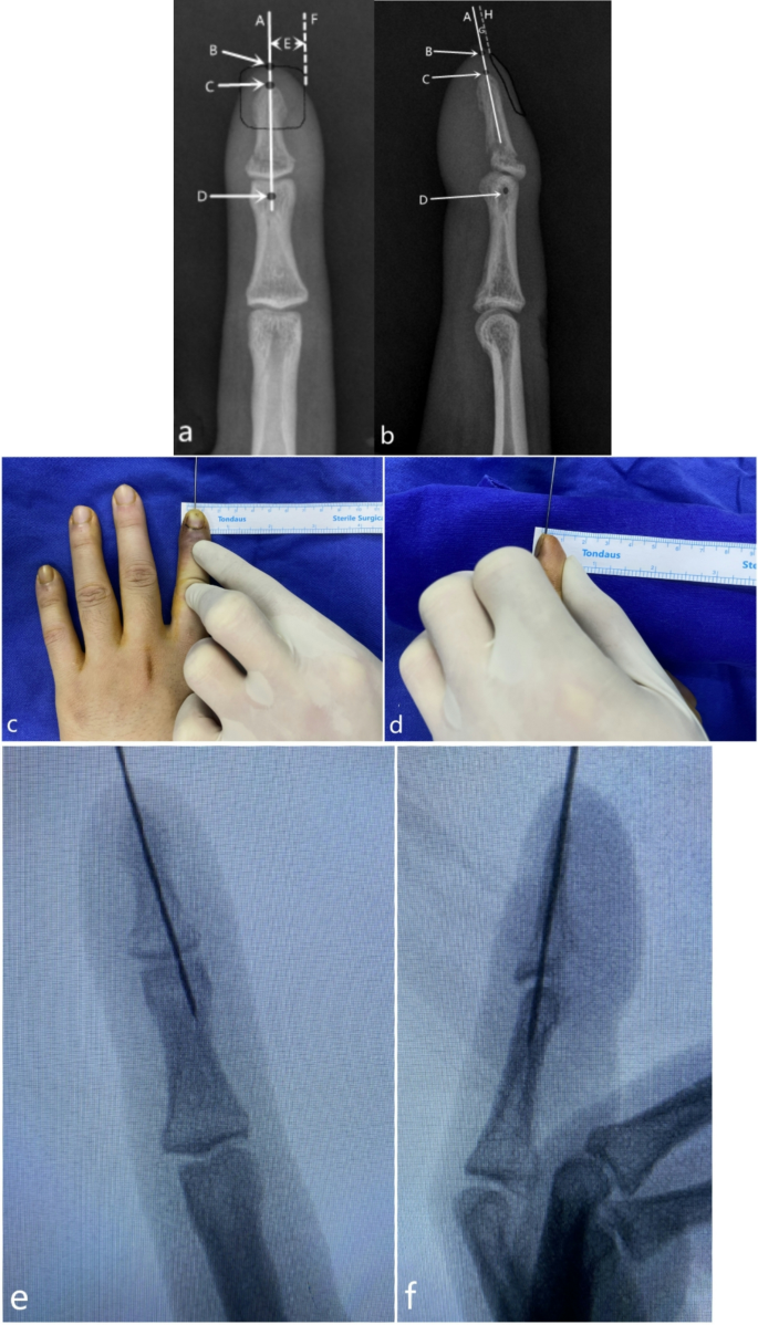 Localizing retrograde K-wire insertion points in distal phalanges using ...
