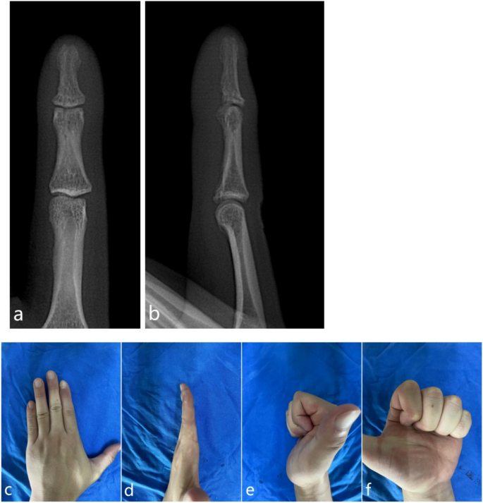 Localizing retrograde K-wire insertion points in distal phalanges using ...