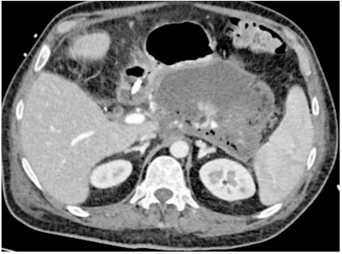 Minimal-invasive percutaneous step-up approach compared to endoscopic ...
